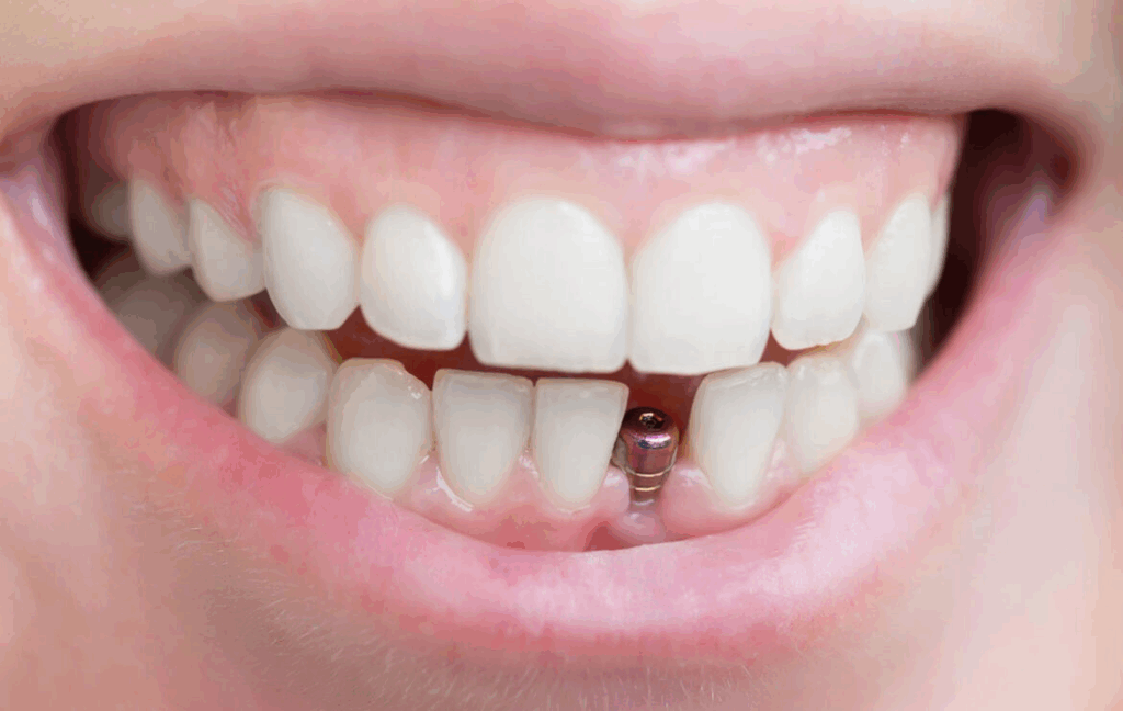 Warning Signs of Dental Implant Infection | Pramukh Dental Care